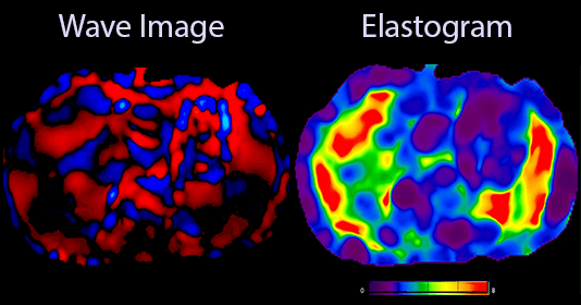 MR Elastography - Telemed Solutions